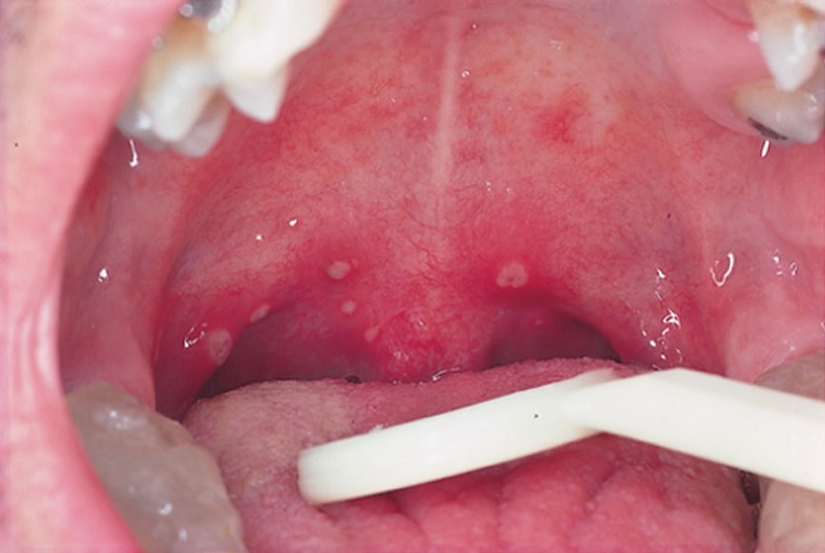 Herpangina: causas, síntomas y tratamiento - eSalud